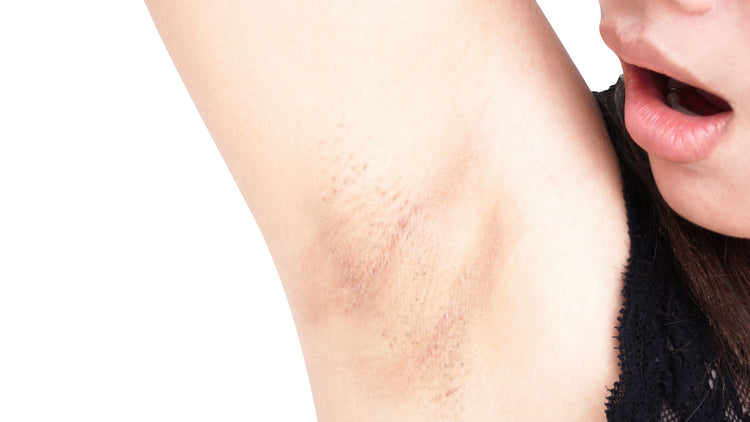 6 Common Causes of Armpits Rashes – Duradry